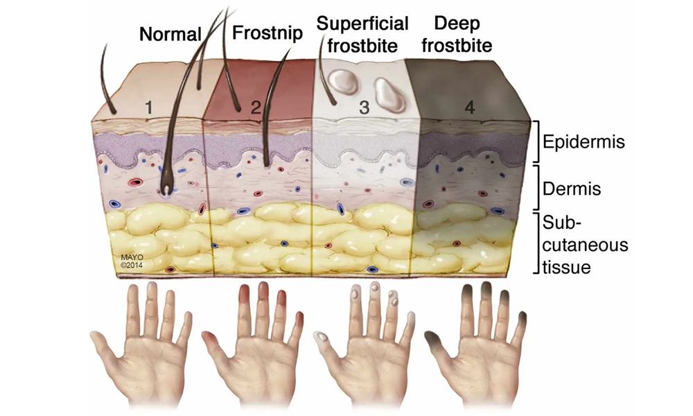 Frosty Grip Brings Frostbite and Other Weather-Related Worries